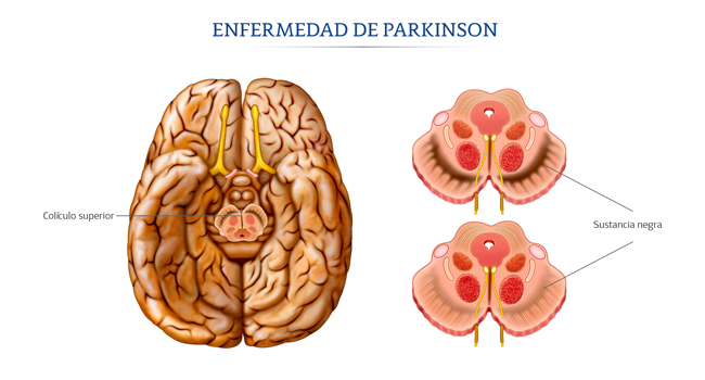 Mal De Parkinson: ¿Qué Es? Causas Y Síntomas – XLQO