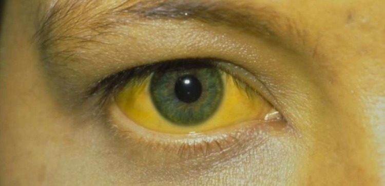 ¿Cómo surge la ictericia? - Agencia Peru